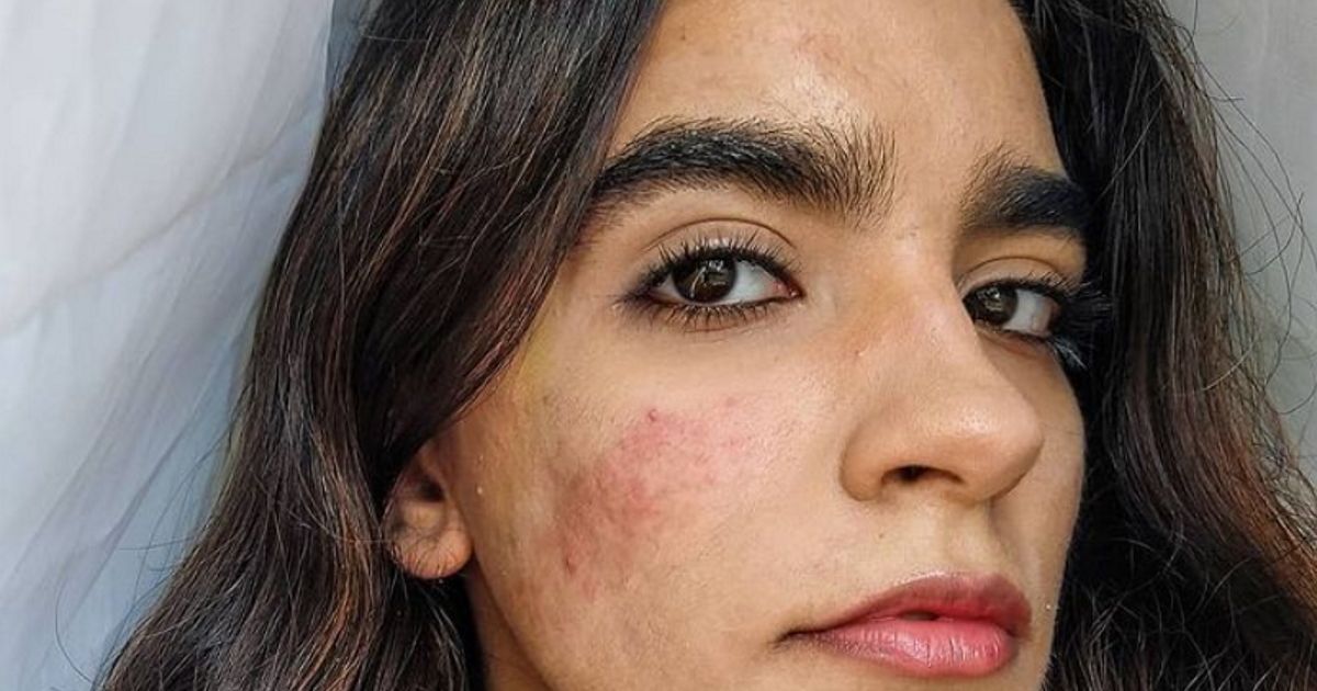 Constanza Concha, l'activiste qui milite pour l'acceptation de l'acné ...