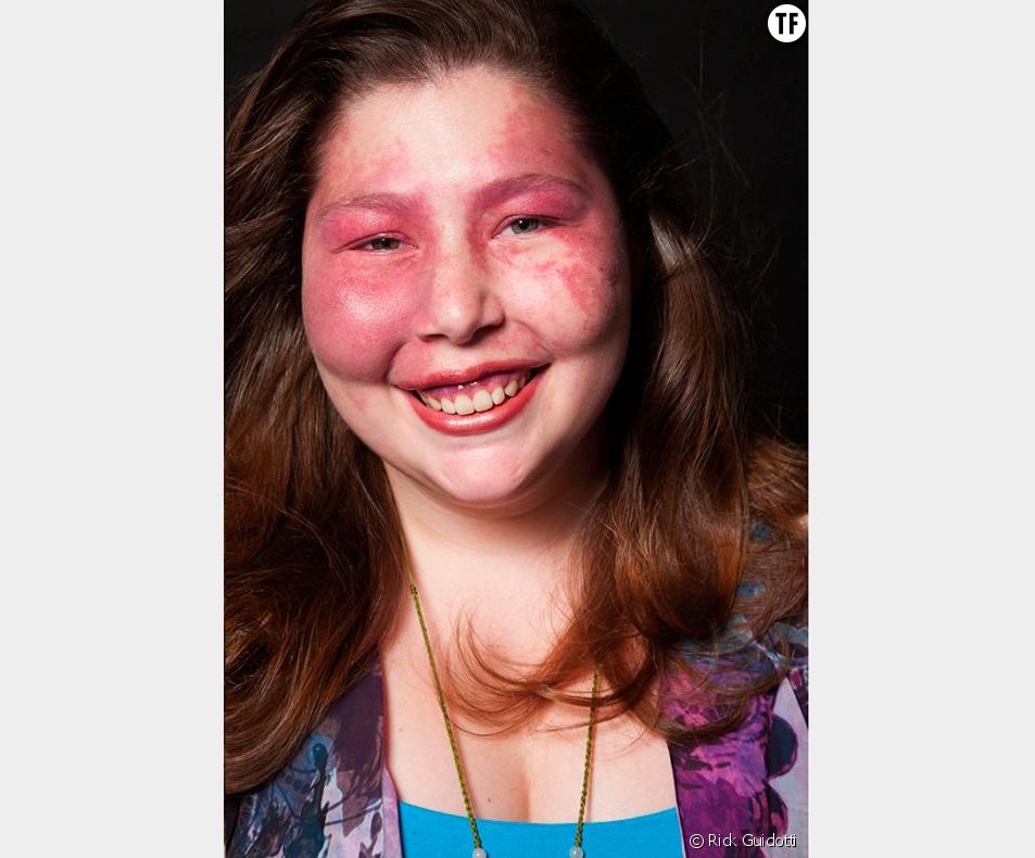 On Beauty : il photographie des malades génétiques pour prouver que la ...